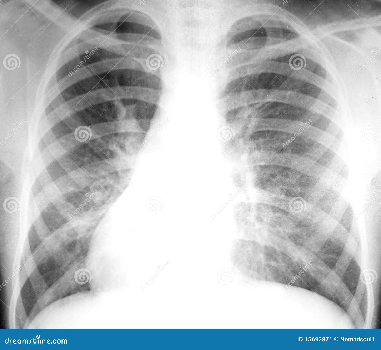 Esame Radiografico Del Torace Immagine Stock - Immagine di bronchite ...