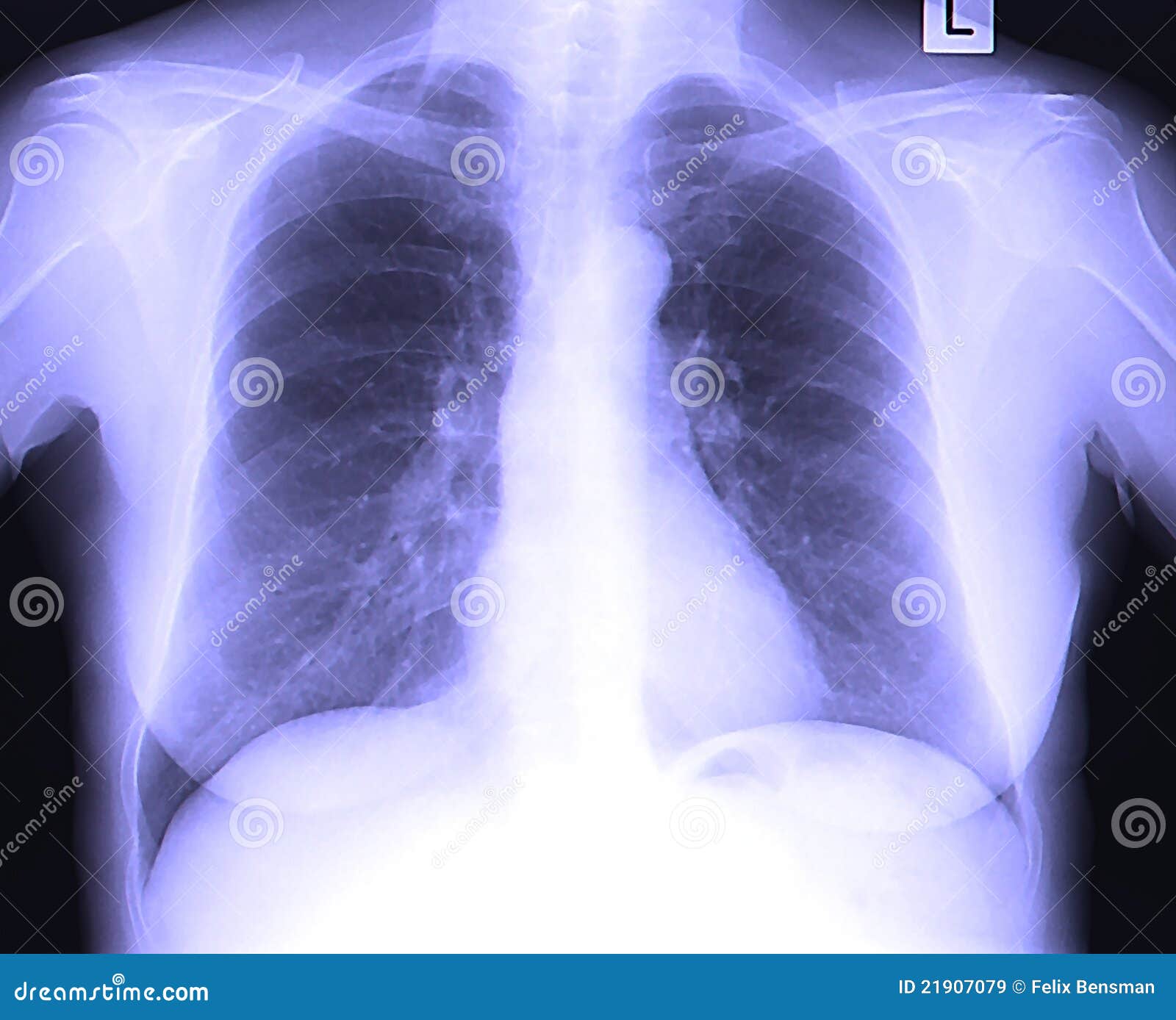 Esame Radiografico Del Torace Immagine Stock - Immagine di pellicola ...