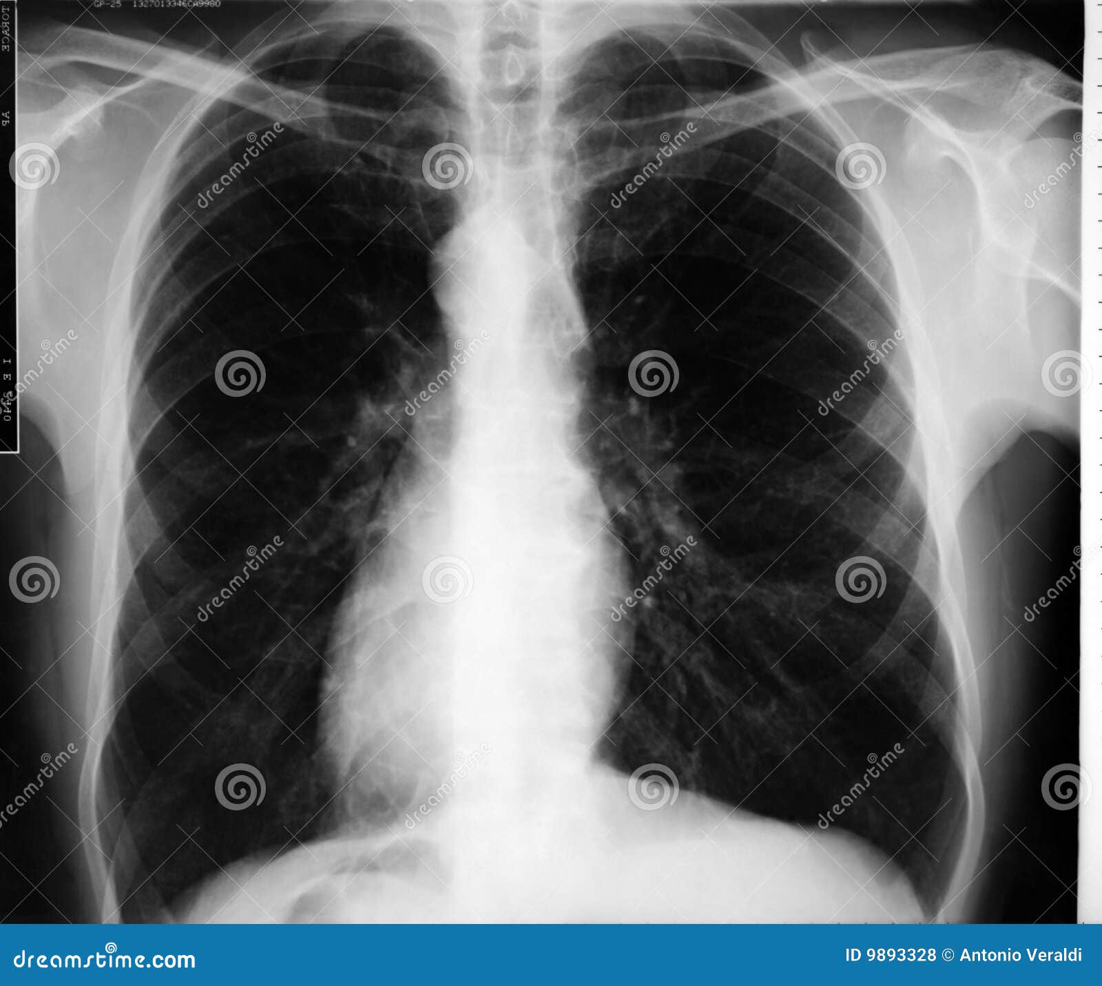 Esame Radiografico Del Torace Fotografia Stock - Immagine di sviluppisi ...