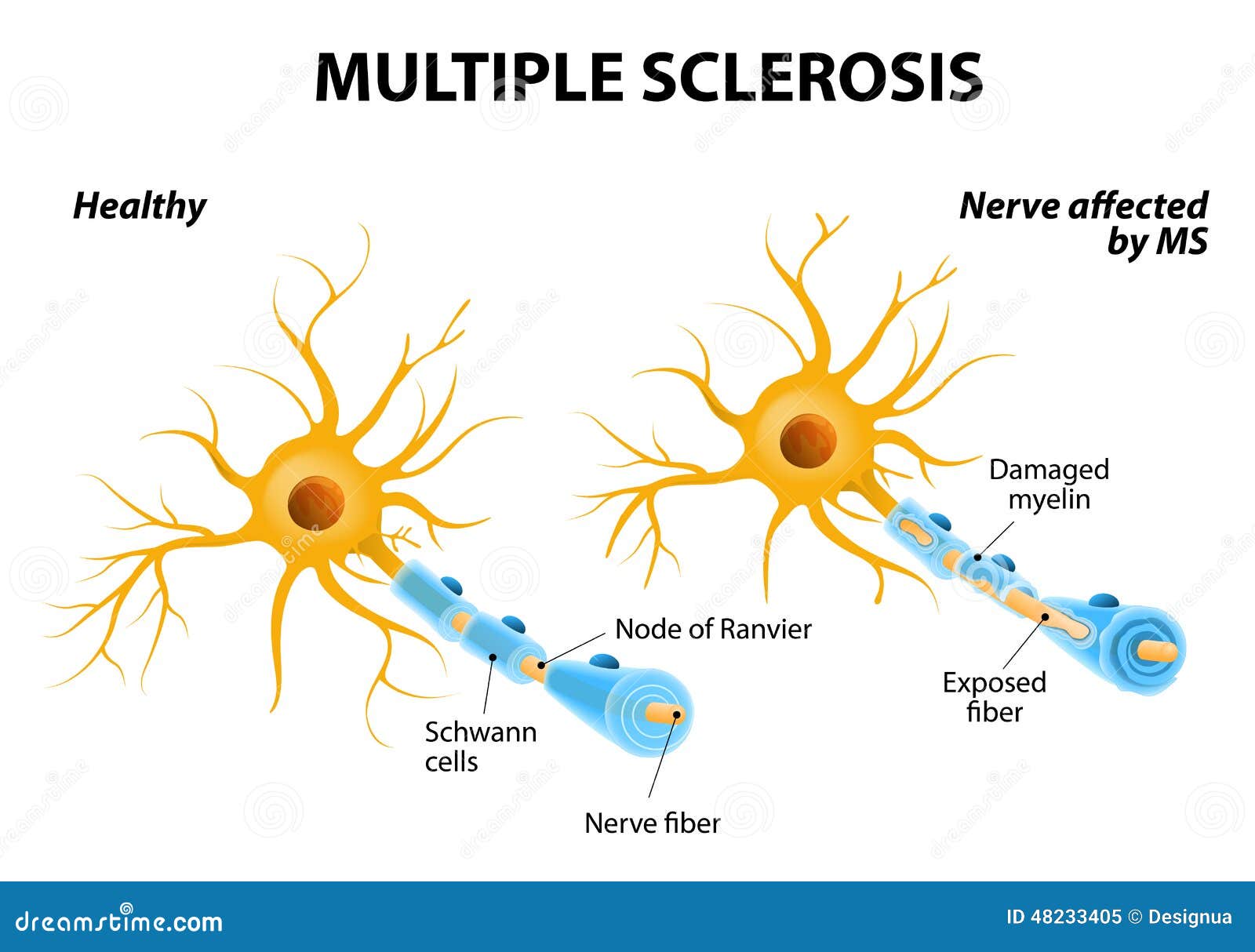 Esclerosis múltiple ilustración del vector. Ilustración de cuerda ...