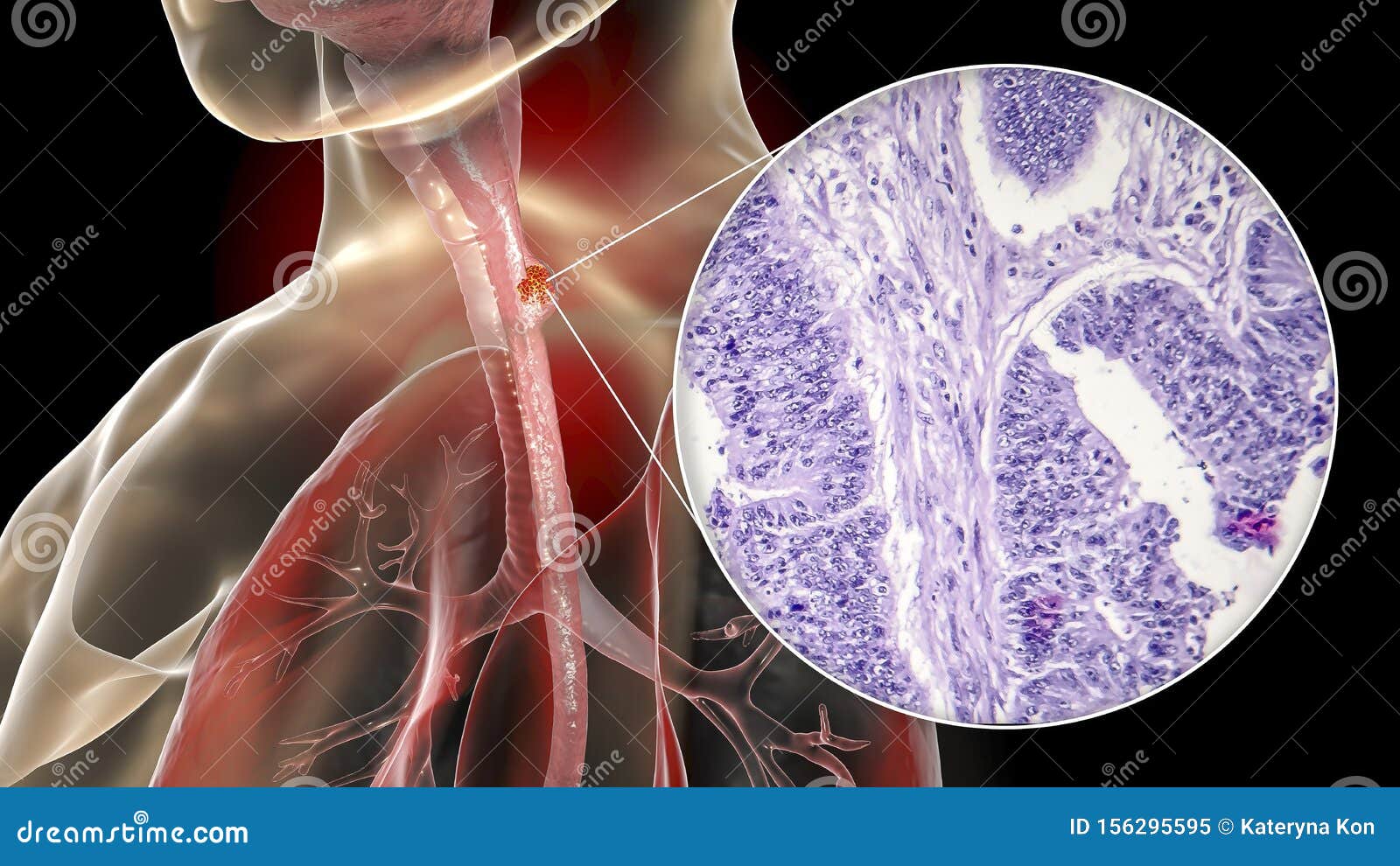 Esophageal Cancer, Illustration and Micrograph Stock Illustration ...