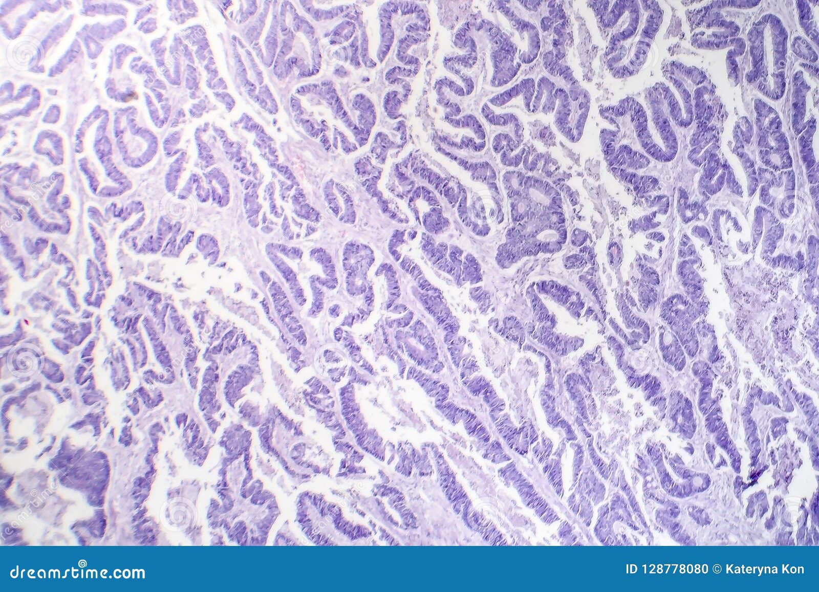 Esophageal Squamous Cell Carcinoma Stock Photo - Image of esophagus ...