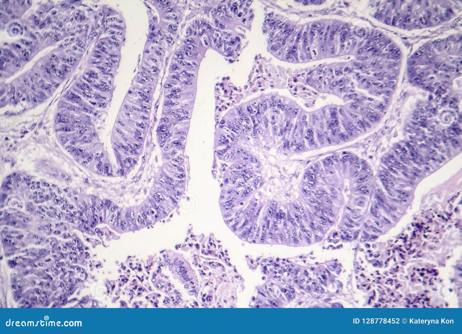 Esophageal Squamous Cell Carcinoma Stock Photography | CartoonDealer ...