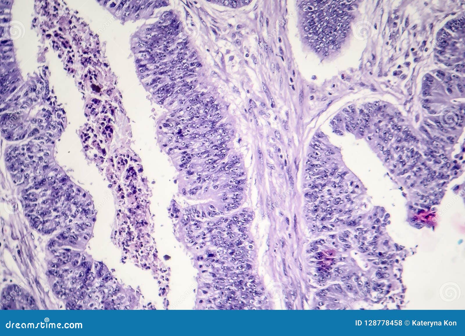 Esophageal Squamous Cell Carcinoma Stock Photo - Image of ...