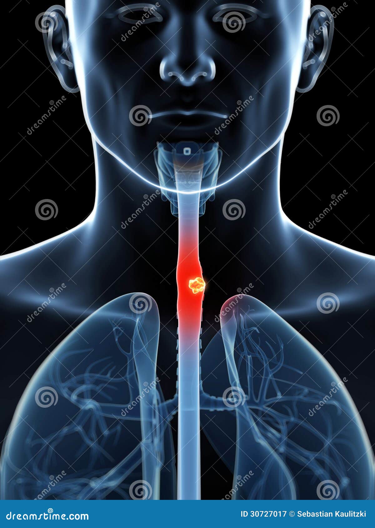 Esophagus cancer stock illustration. Illustration of inflamed - 30727017