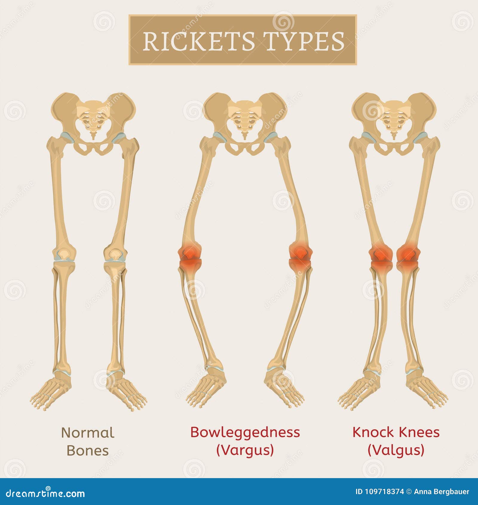Definicin De Raquitismo Concepto En Definicin Abc