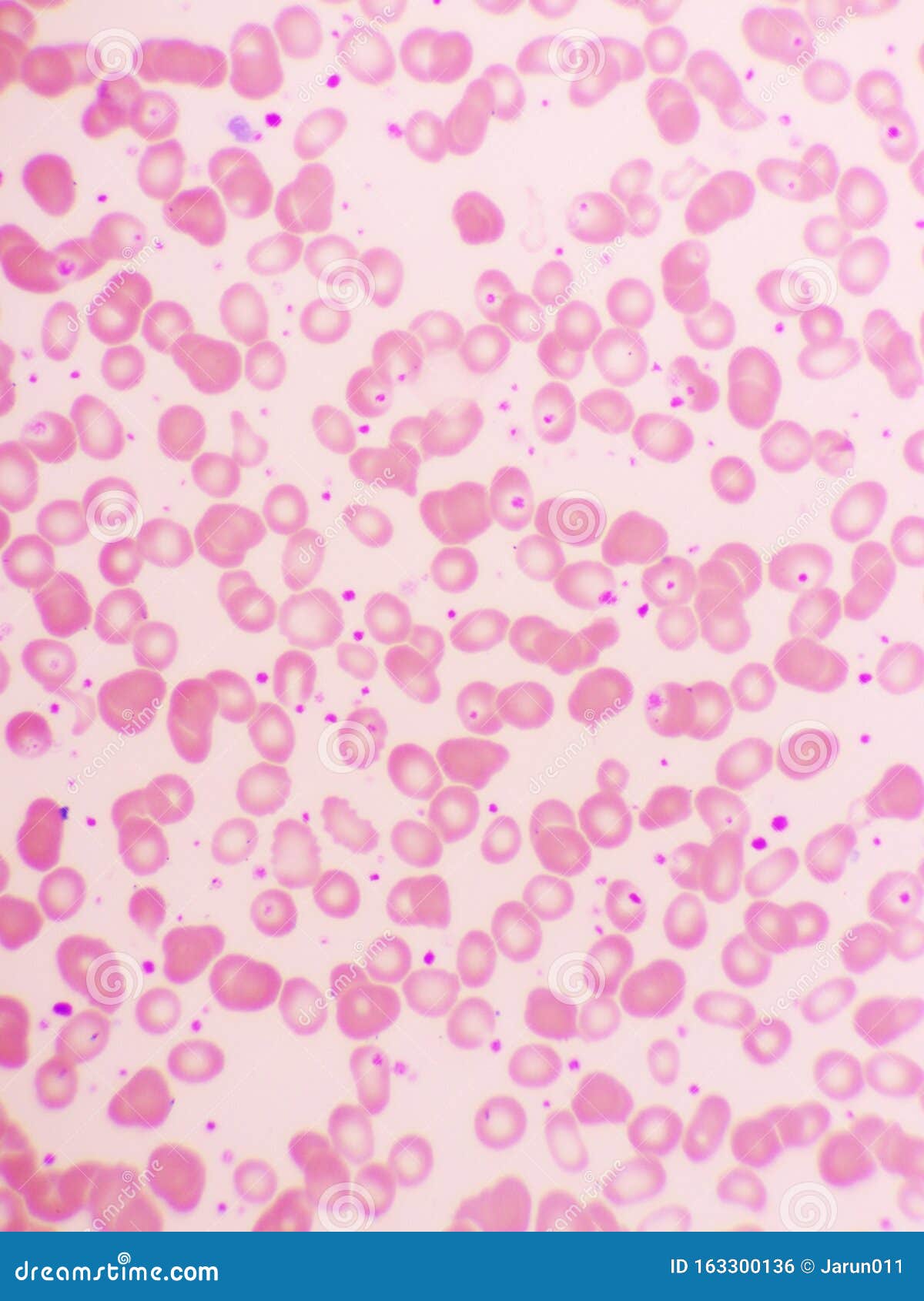 Essential Thrombocytosis Blood Smear Stock Photo - Image of examination ... Essential Thrombocytosis Blood Smear Stock Photo - Image of examination ...