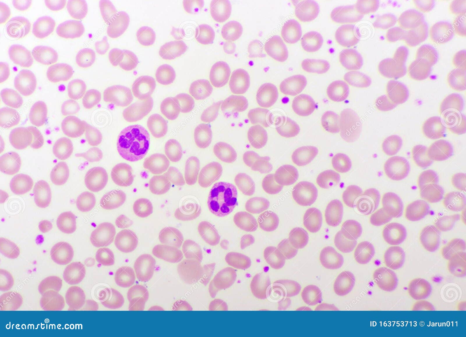 Essential Thrombocytosis Blood Smear Stock Image | CartoonDealer.com ... Essential Thrombocytosis Blood Smear Stock Image | CartoonDealer.com ...