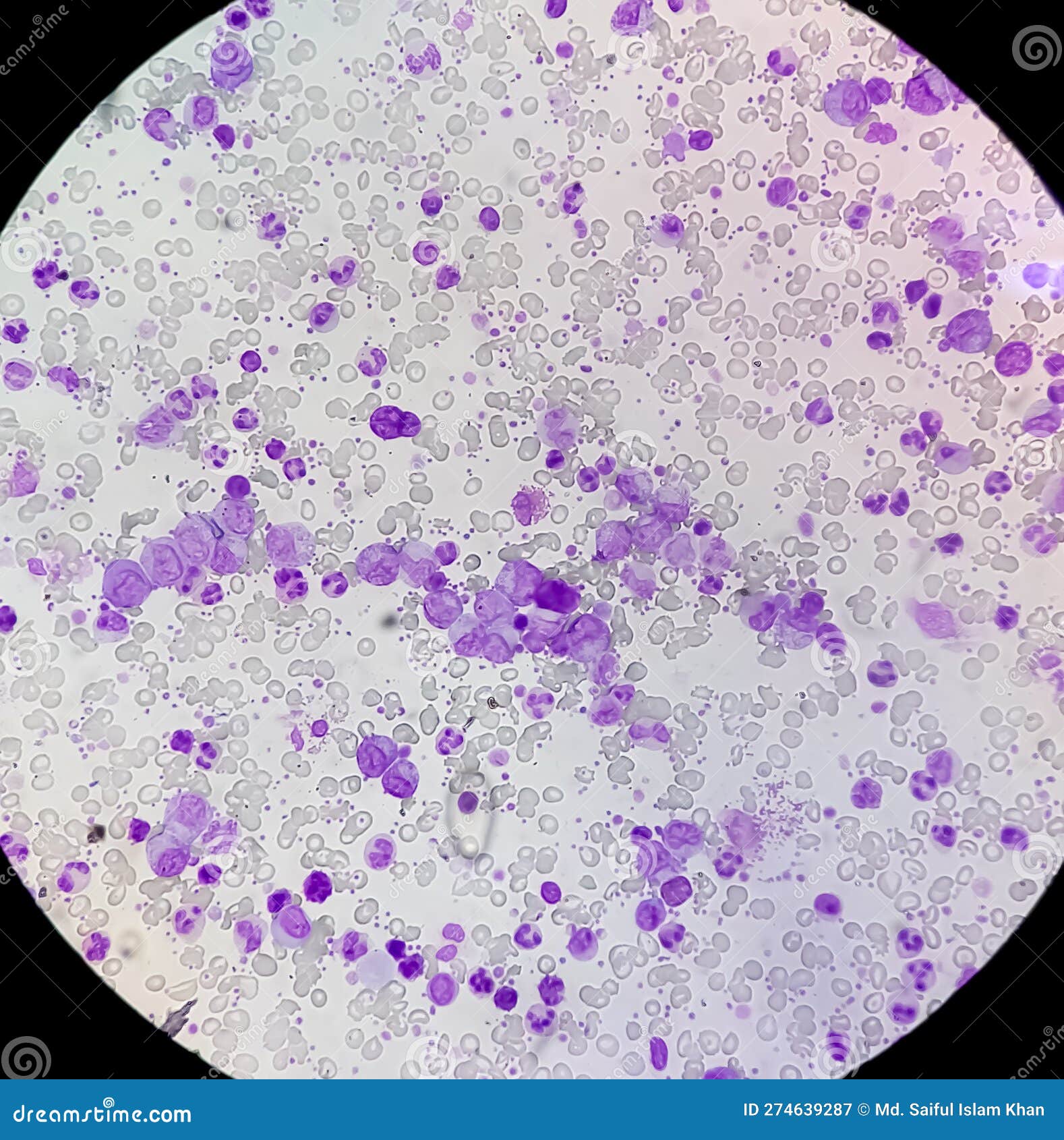 Essential Thrombocytosis, Abnormal High Volume of Platelet and White Blood Cell Stock Image ...