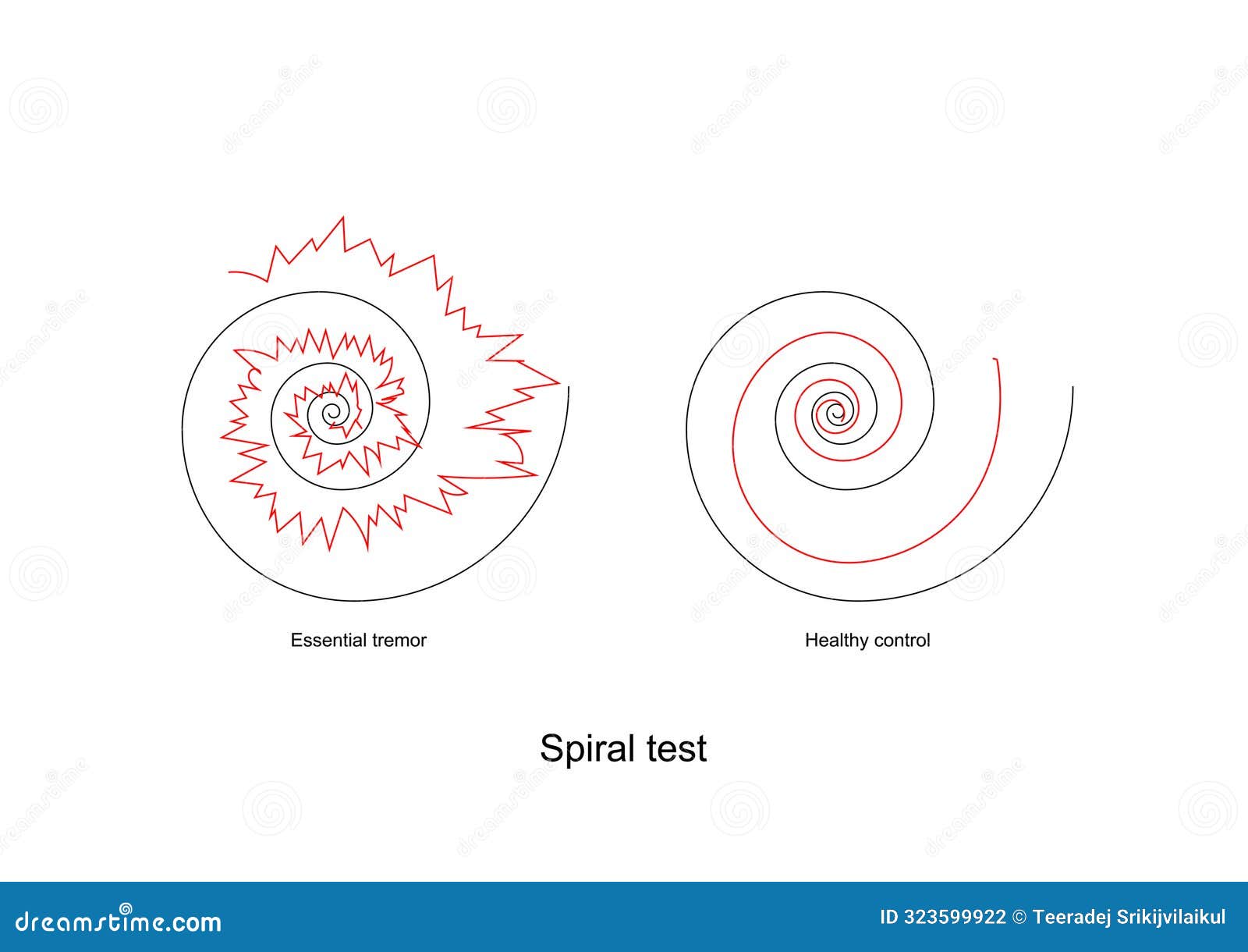 Essential Tremor Versus Healthy Control Spiral Test Stock Illustration ...