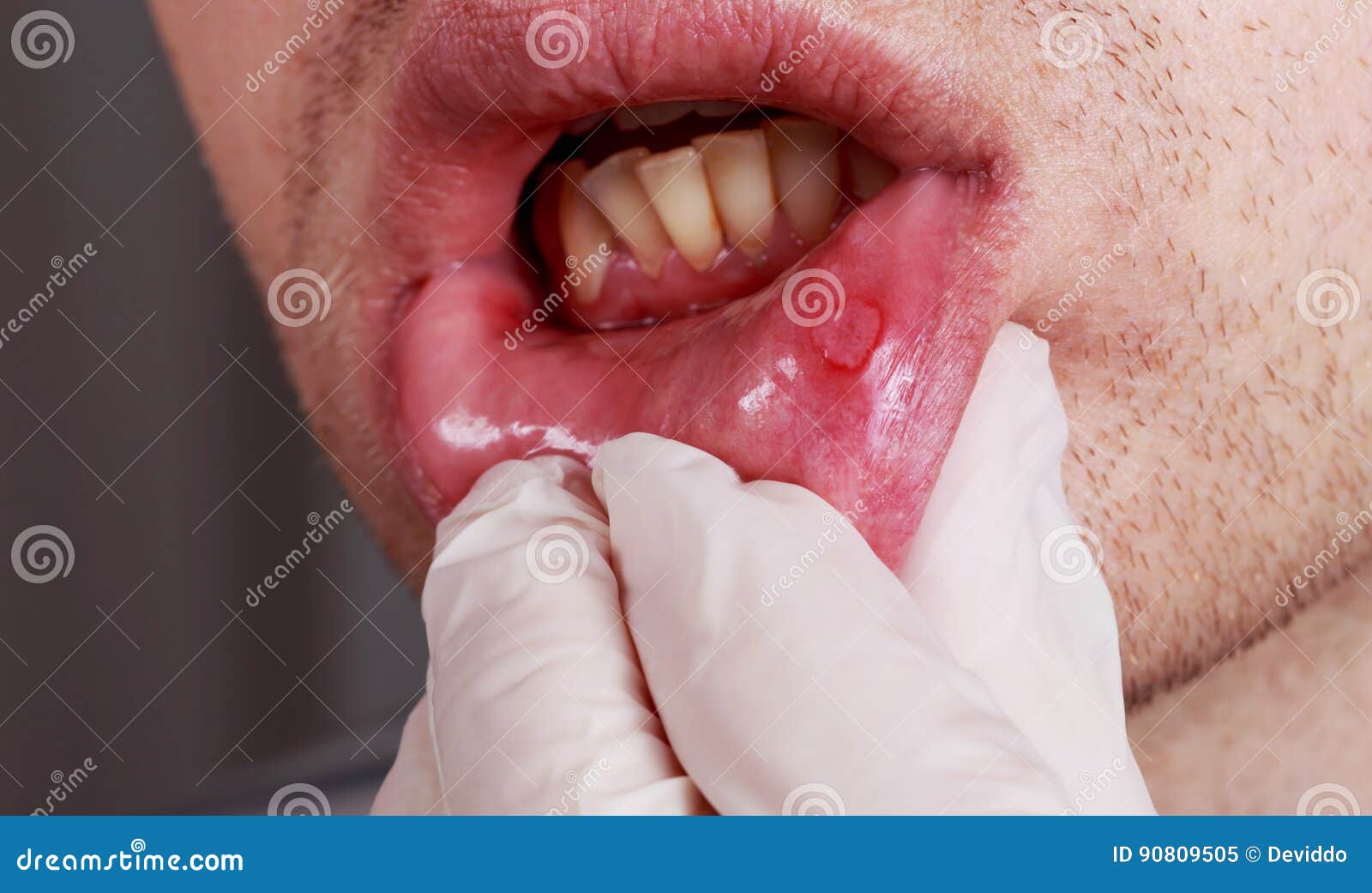Estomatitis en los labios imagen de archivo. Imagen de guantes - 90809505