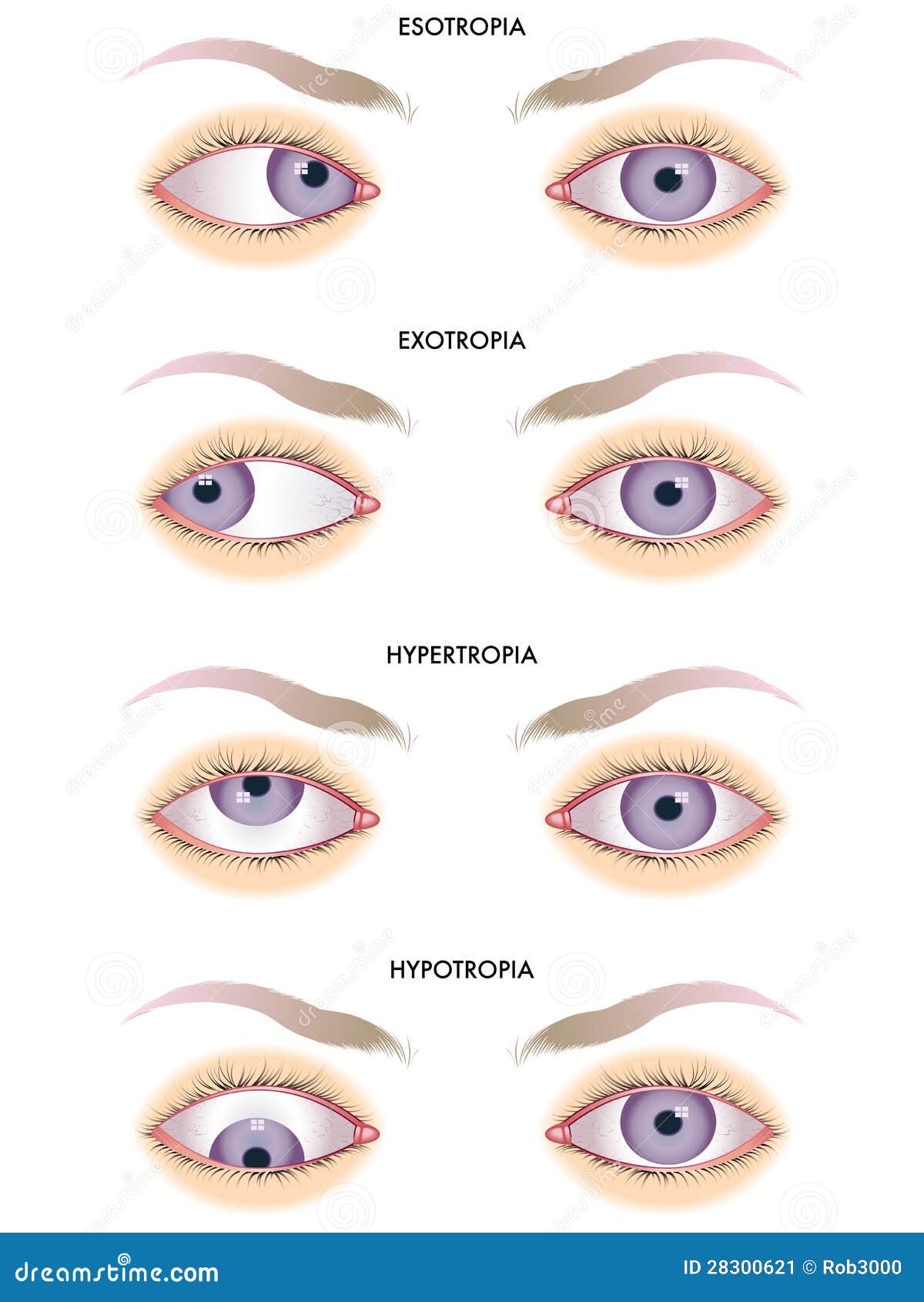 Estrabismo ilustración del vector. Ilustración de ocular - 28300621