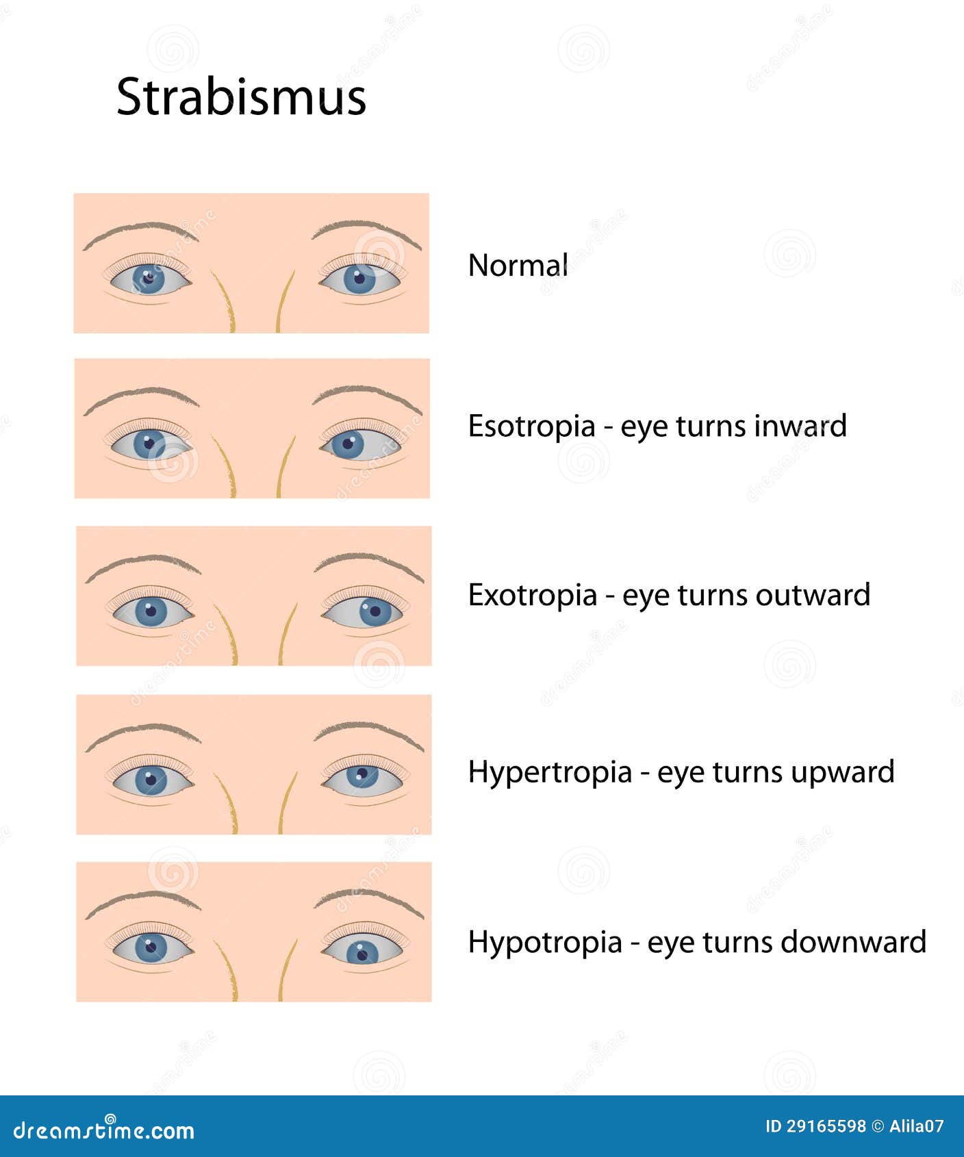 Estrabismo ilustração do vetor. Ilustração de pupila - 29165598