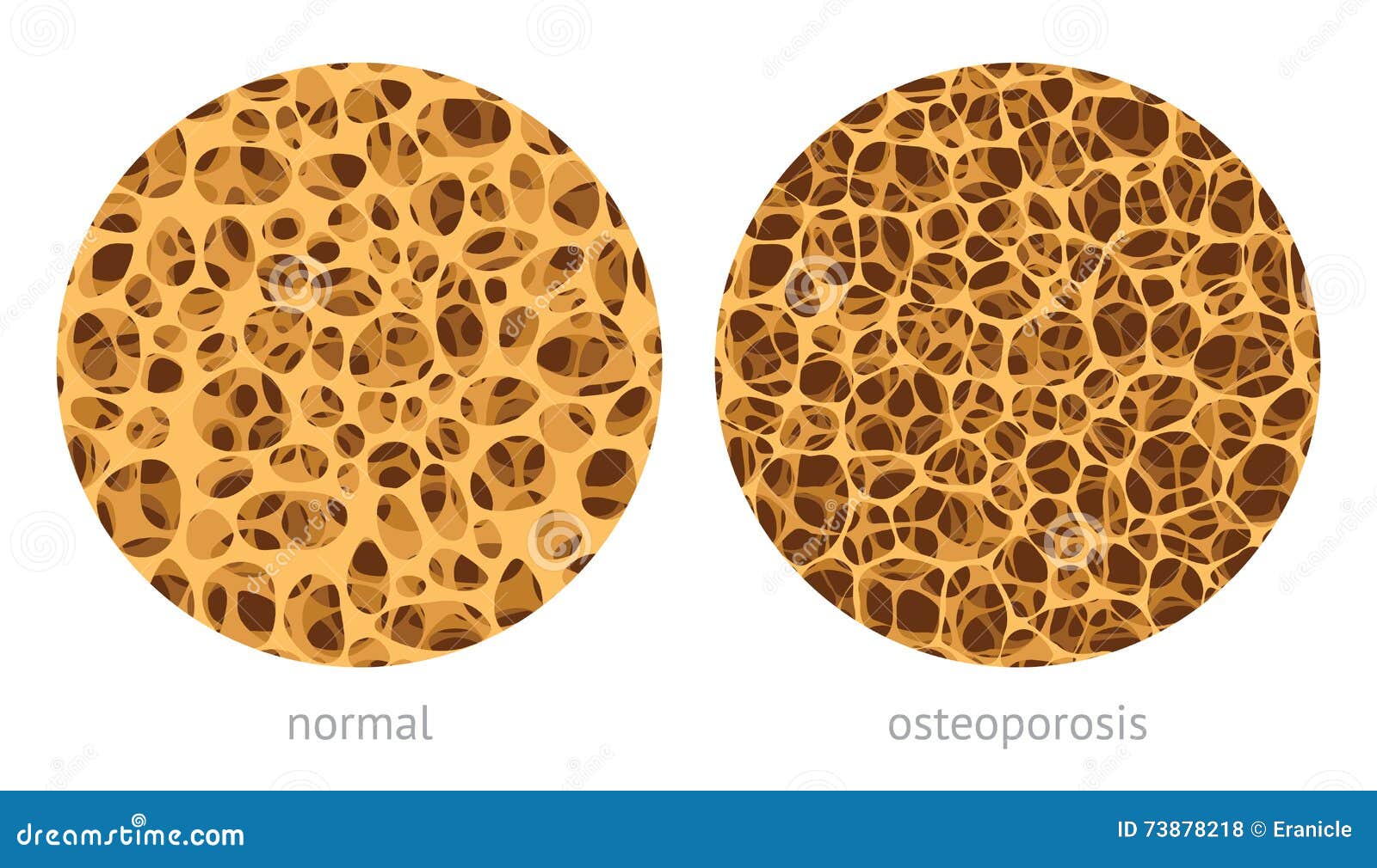 Estrutura Esponjosa Do Osso Ilustração do Vetor - Ilustração de corpo ...