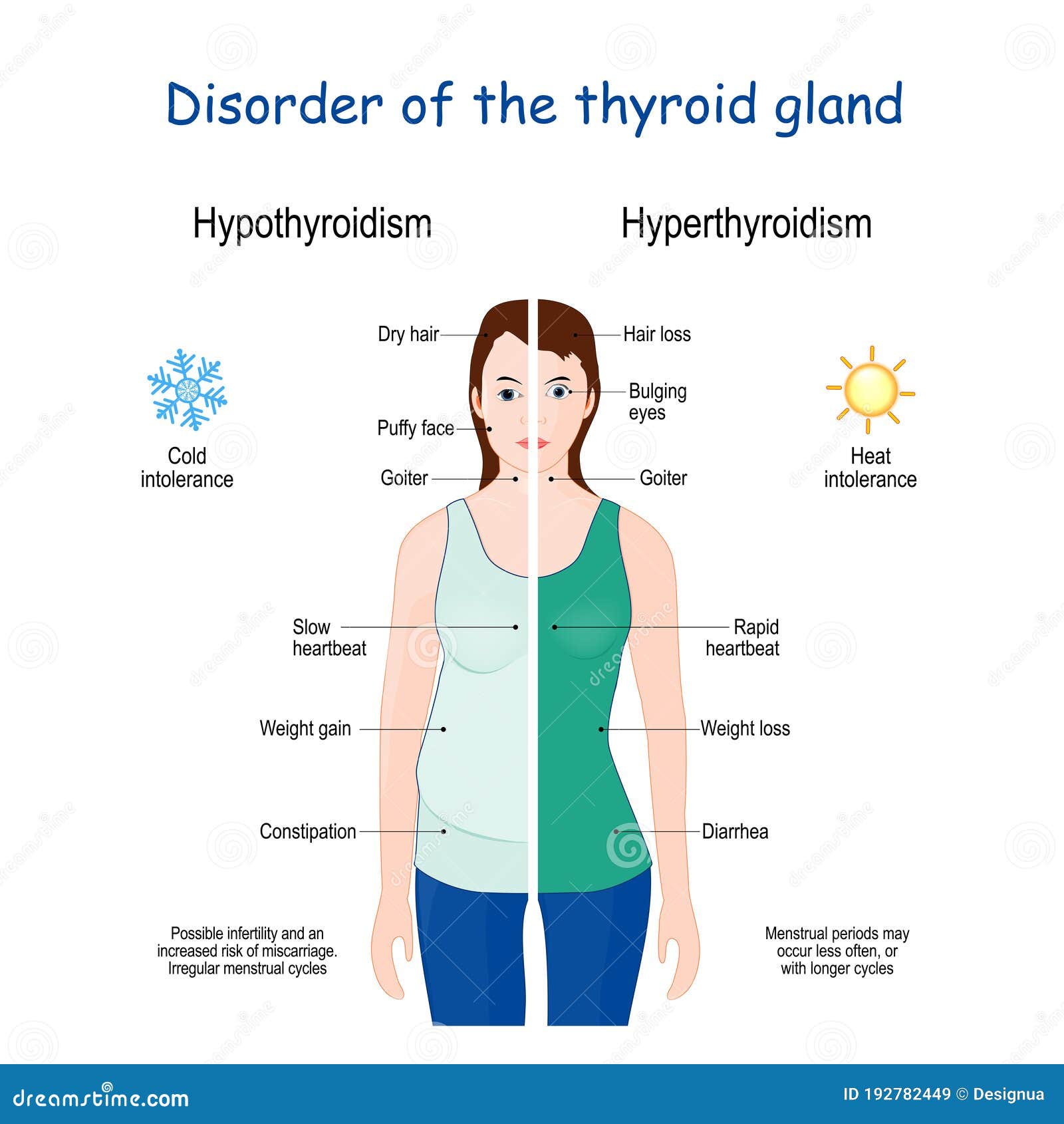 Et Hyperthyroïdisme Hypothyroïdie Féminine Avec Des Signes Et Symptômes Des Maladies De La