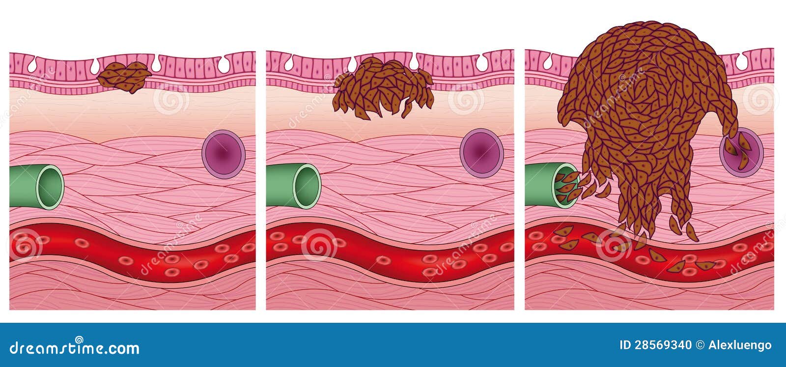 Etapas de un cáncer stock de ilustración. Ilustración de malo - 28569340