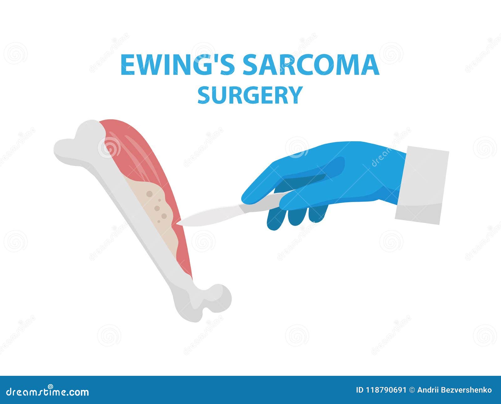 Ewing S Sarcoma Surgery Vector Illustration Isolated on White ...