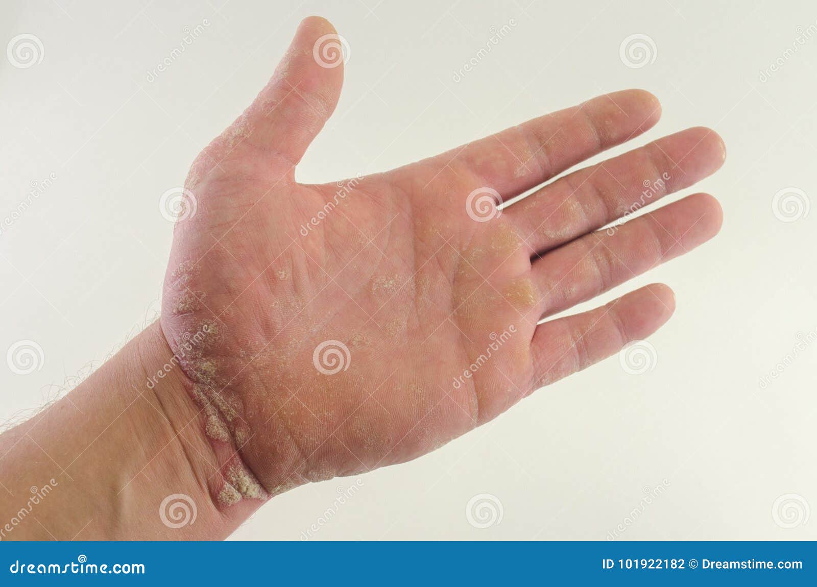 Exacerbación Del Psoriasis En Las Manos Foto de archivo - Imagen de ...