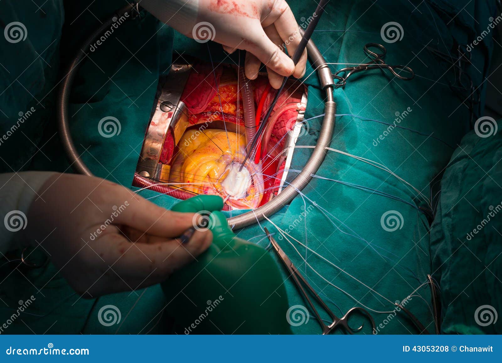 Exam Mitral Valve Leaflet Both Anterior and Posterior Stock Photo ...