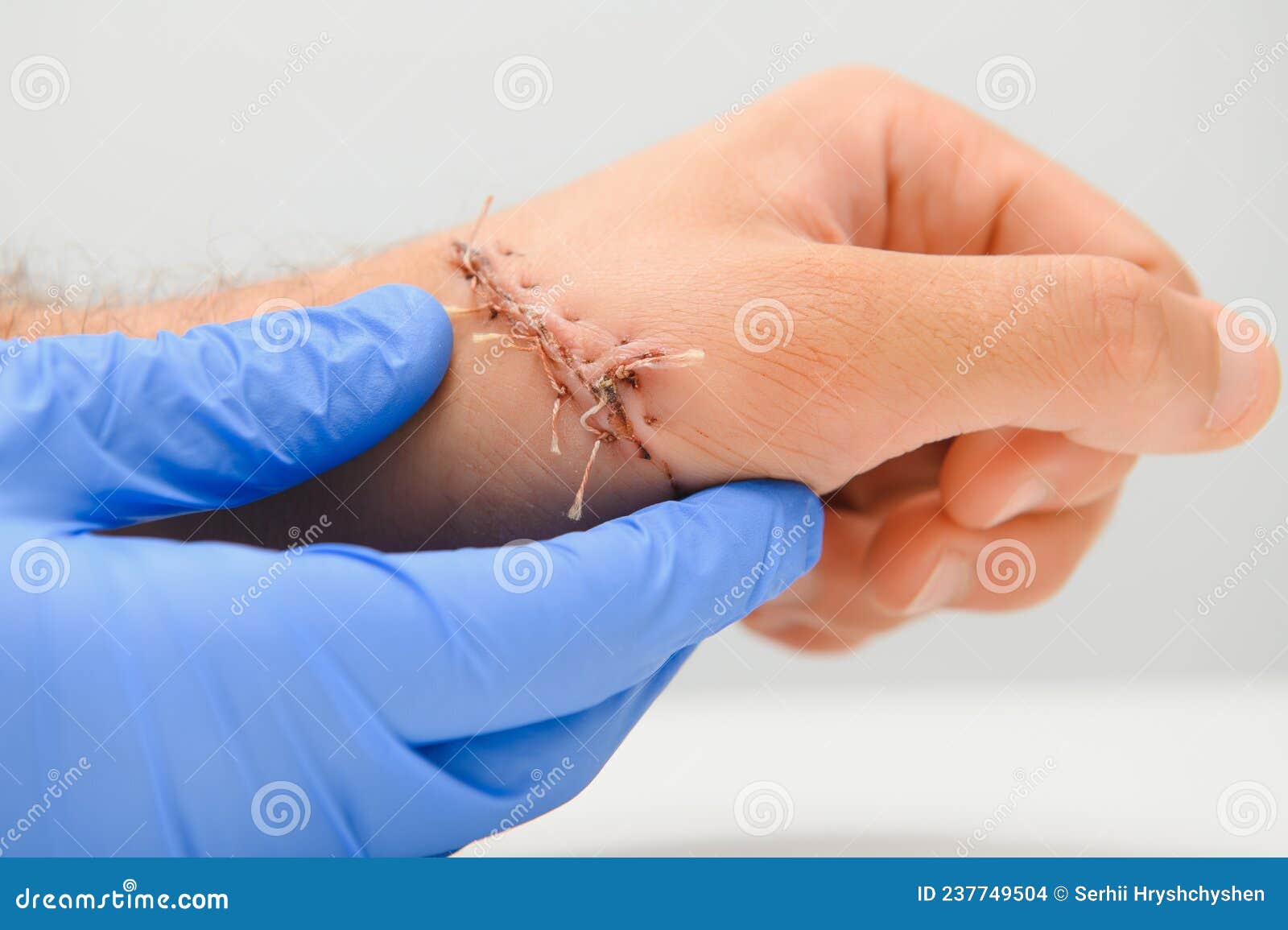 Examination by a Doctor of a Cut on the Arm Stock Photo - Image of ...