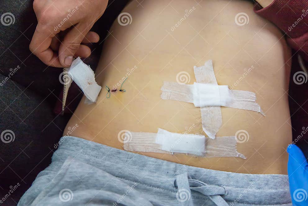 Examination of the Patient by a Doctor after Removal of the Appendix ...