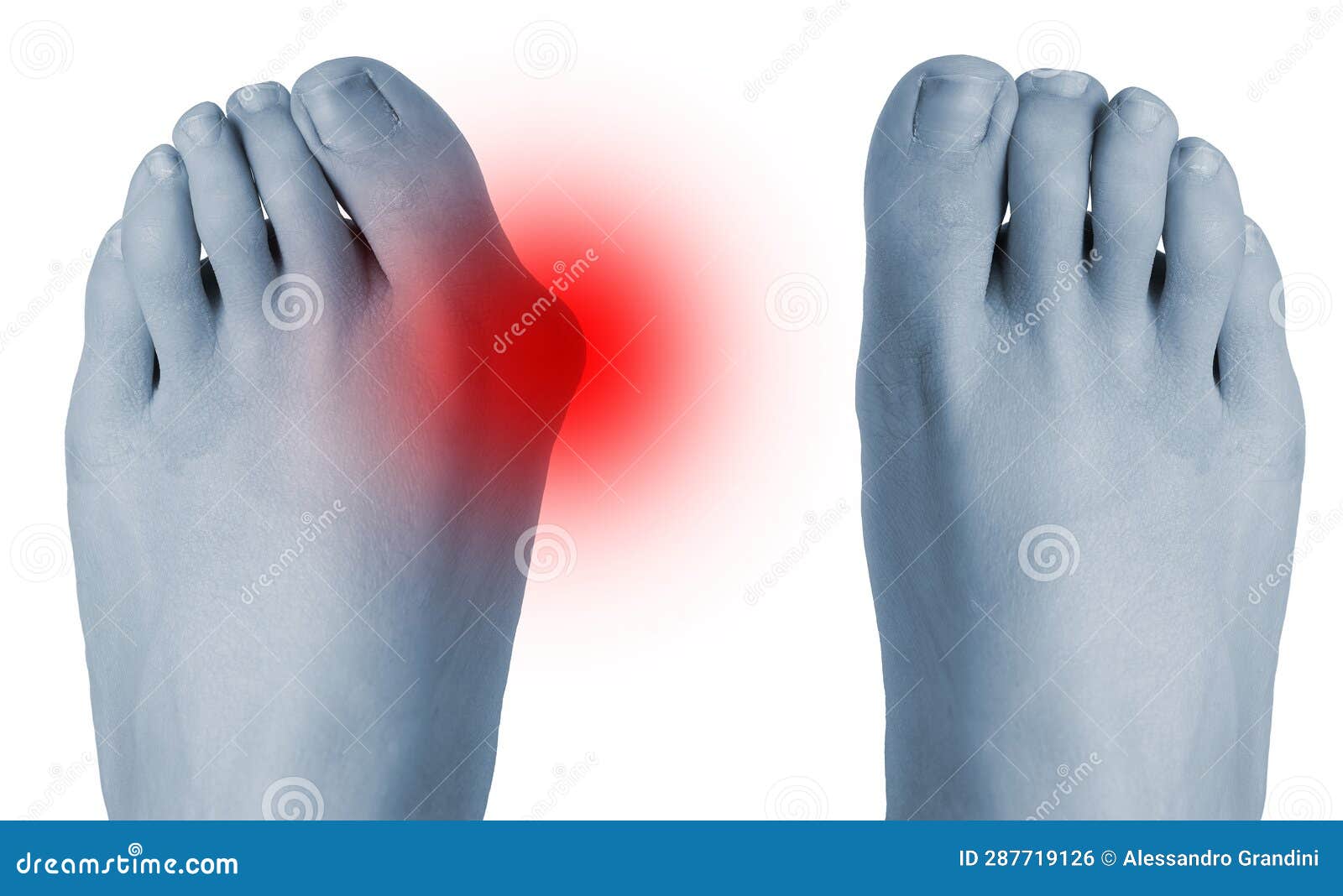 Feet before and after Surgical Correction of Hallux Valgus Stock Photo ...