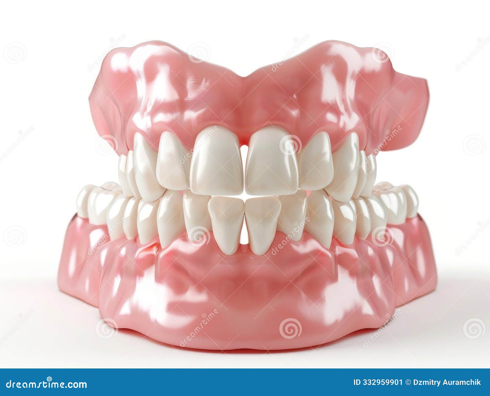 An Example of an Open Flap Procedure, Showing Bone Loss. a Medically ...
