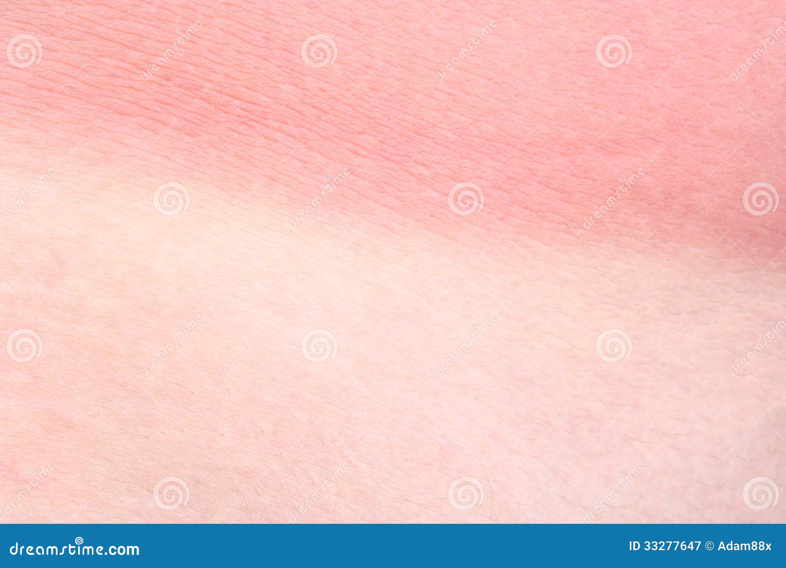 Example sunburn skin stock image. Image of cancer, irritation - 33277647