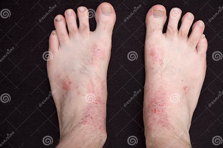 Excema stock image. Image of rough, dermatitis, inflammation - 11159197