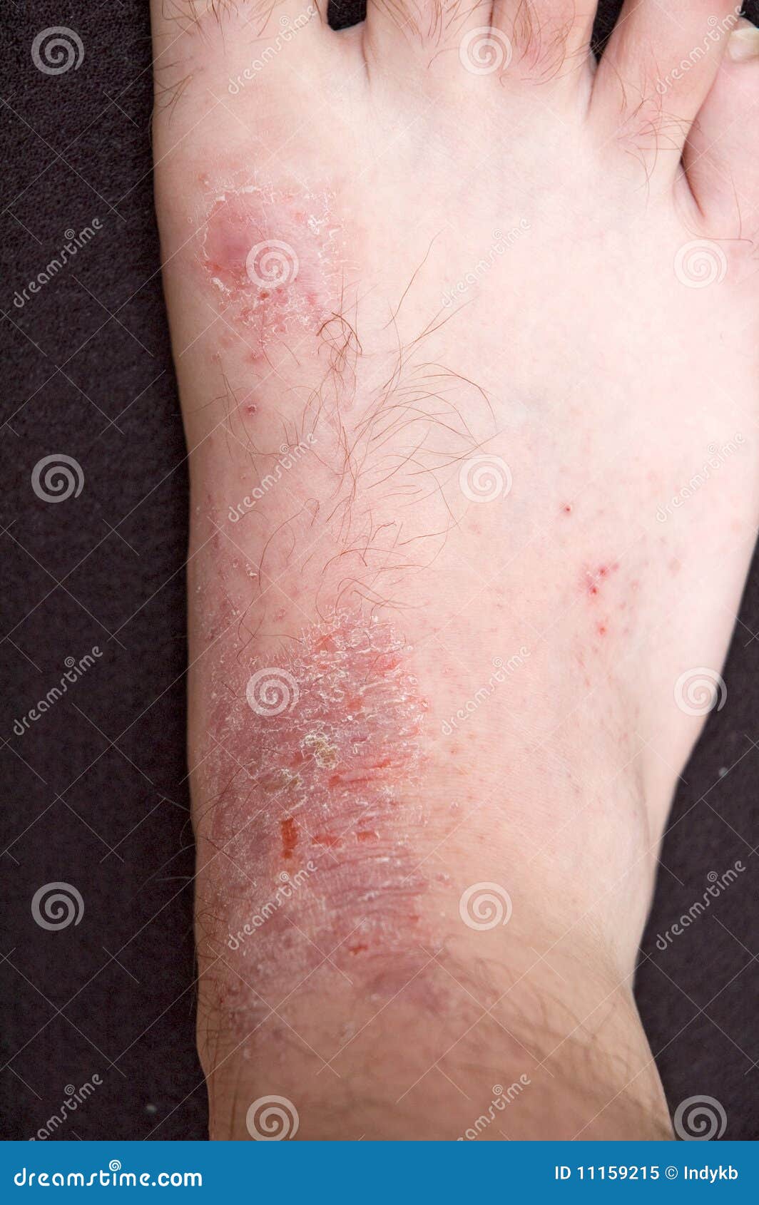 Eczema On Top Of Feet