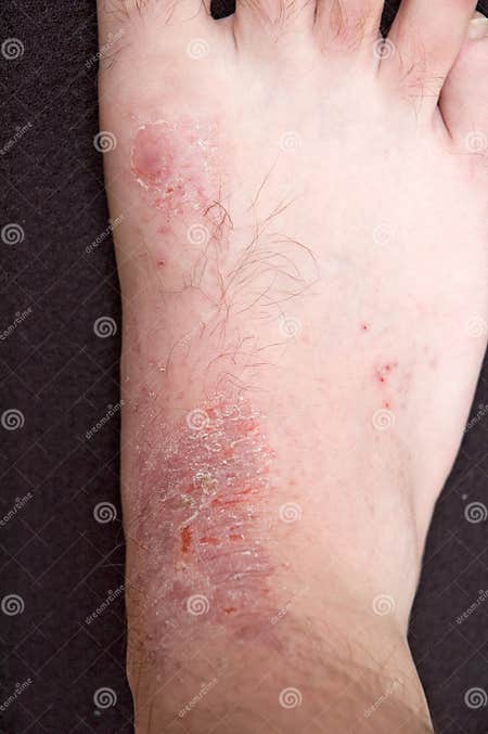 Excema stock image. Image of feet, inflammation, epidermis - 11159215