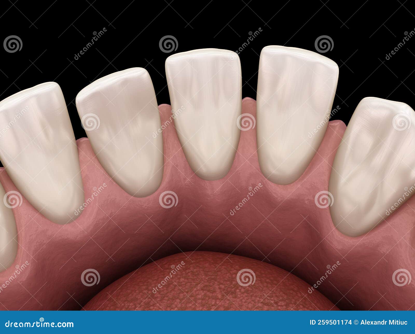 Spacing Teeth Diastema Vector Illustration | CartoonDealer.com #93804838
