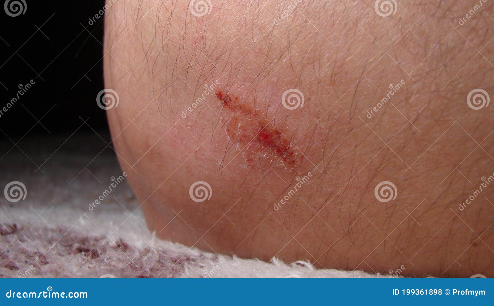 Excoriation Wound on an Arm | Wound Healing . Medicine Stock Photo ...