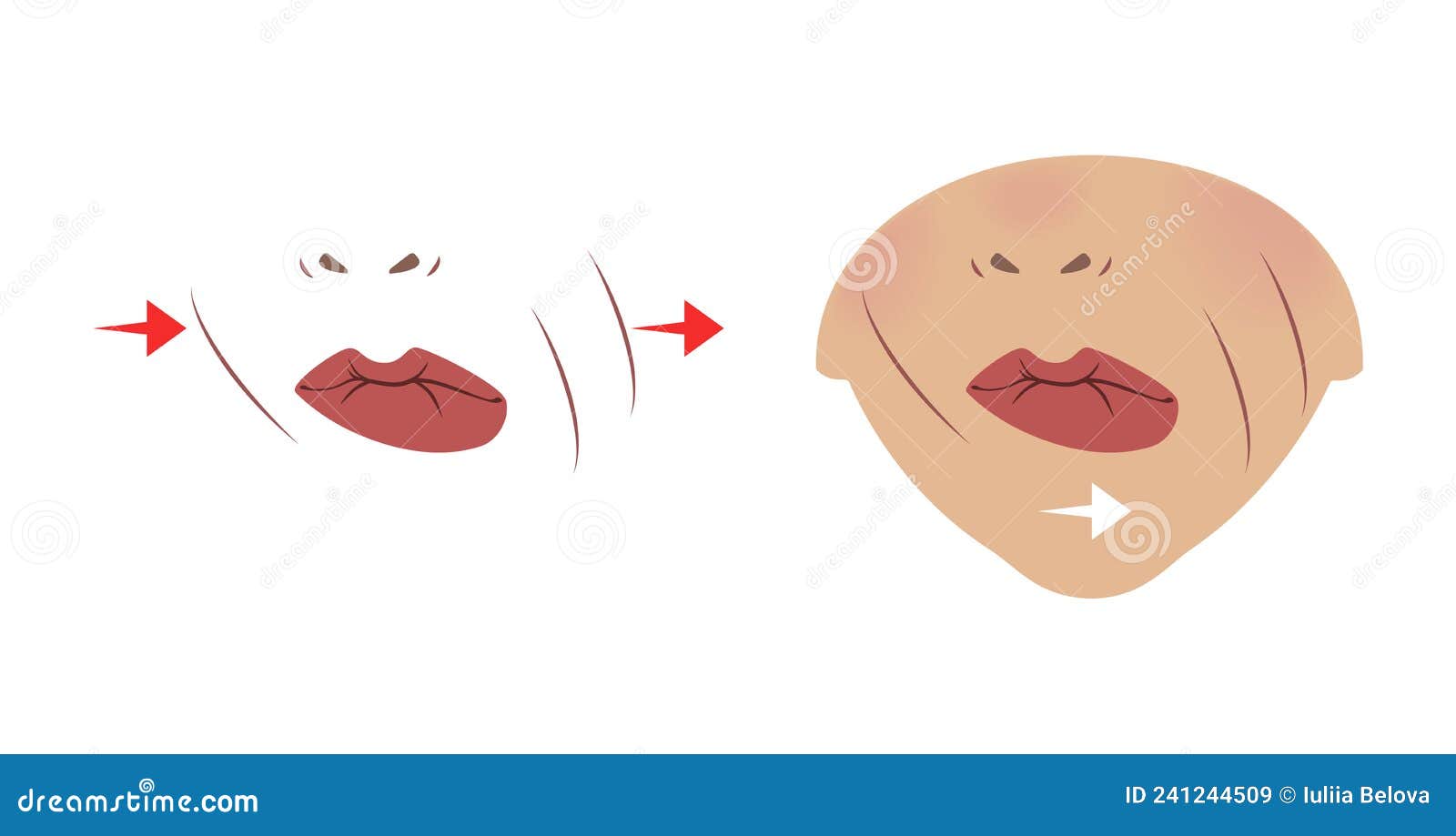 Exercises for the Expression Muscles Around the Lips and Mouth ...