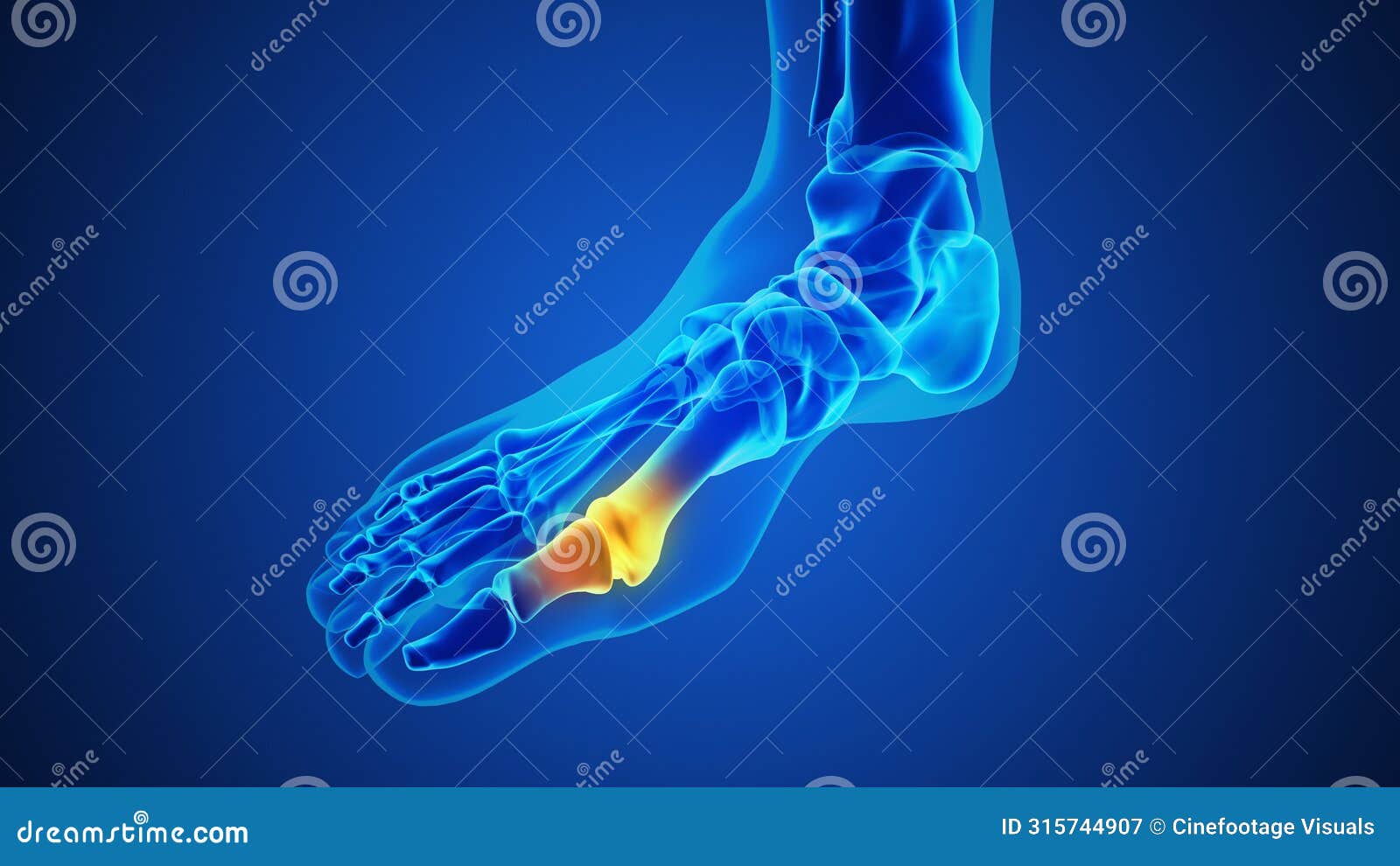 Painful Gout Inflammation on Big Toe Joint Stock Illustration ...