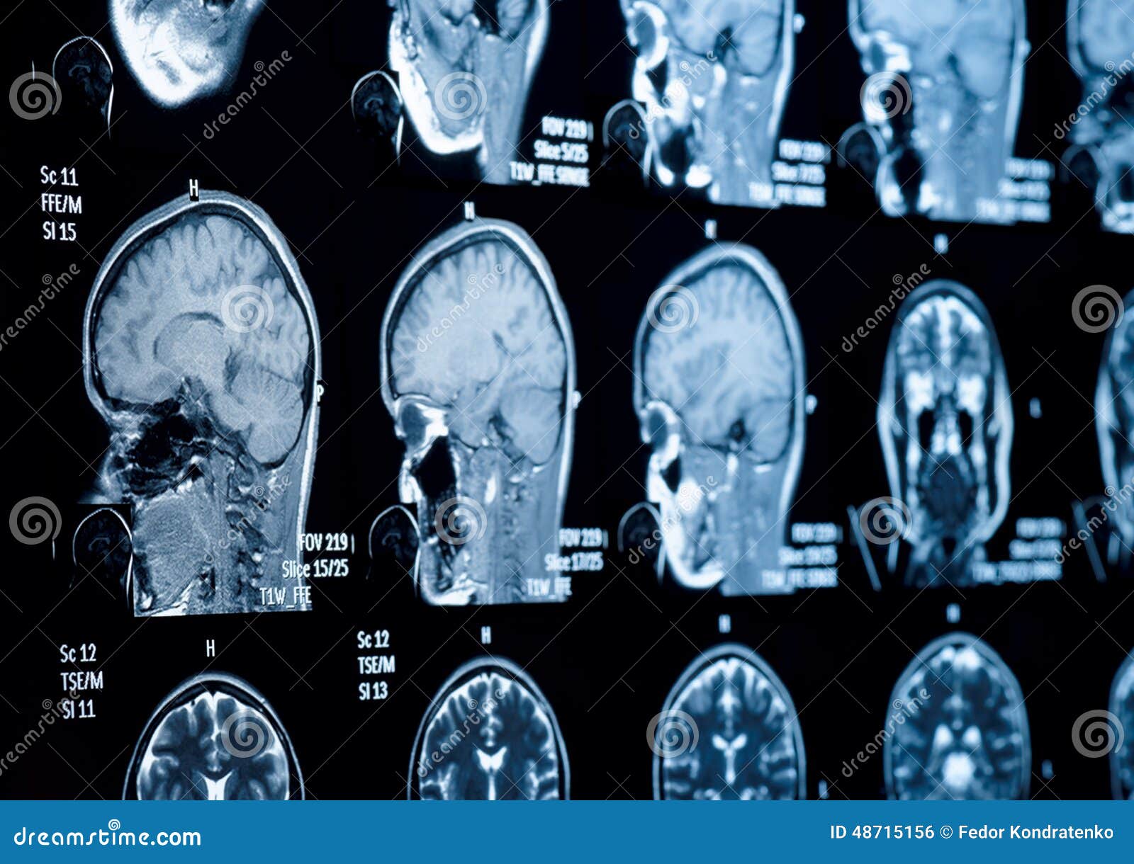 Exploración De La Cabeza Y Del Cuello MRI, Anonymized Foto de archivo ...
