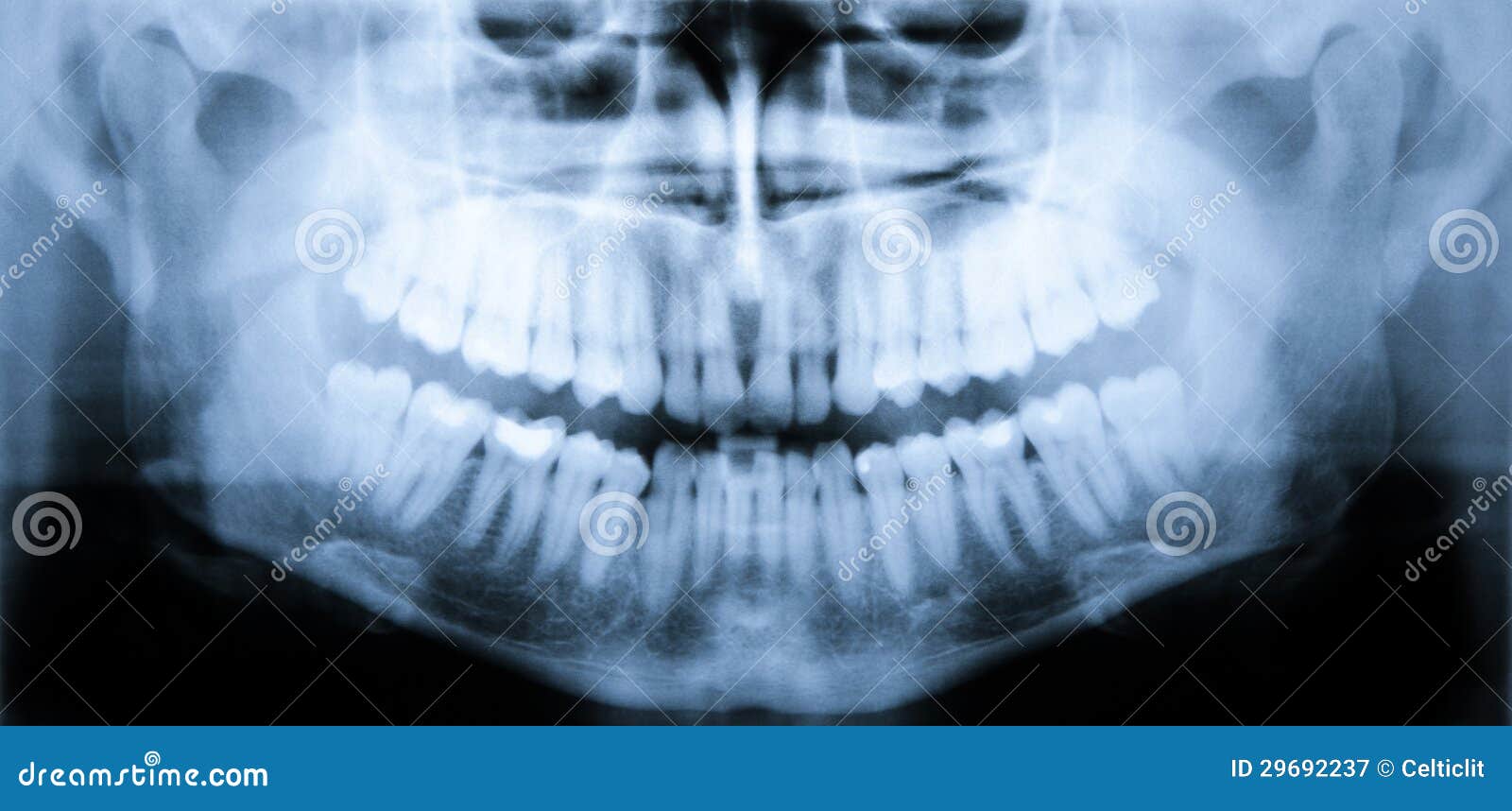 Exploración De La Radiografía De Dientes Imagen de archivo - Imagen de ...