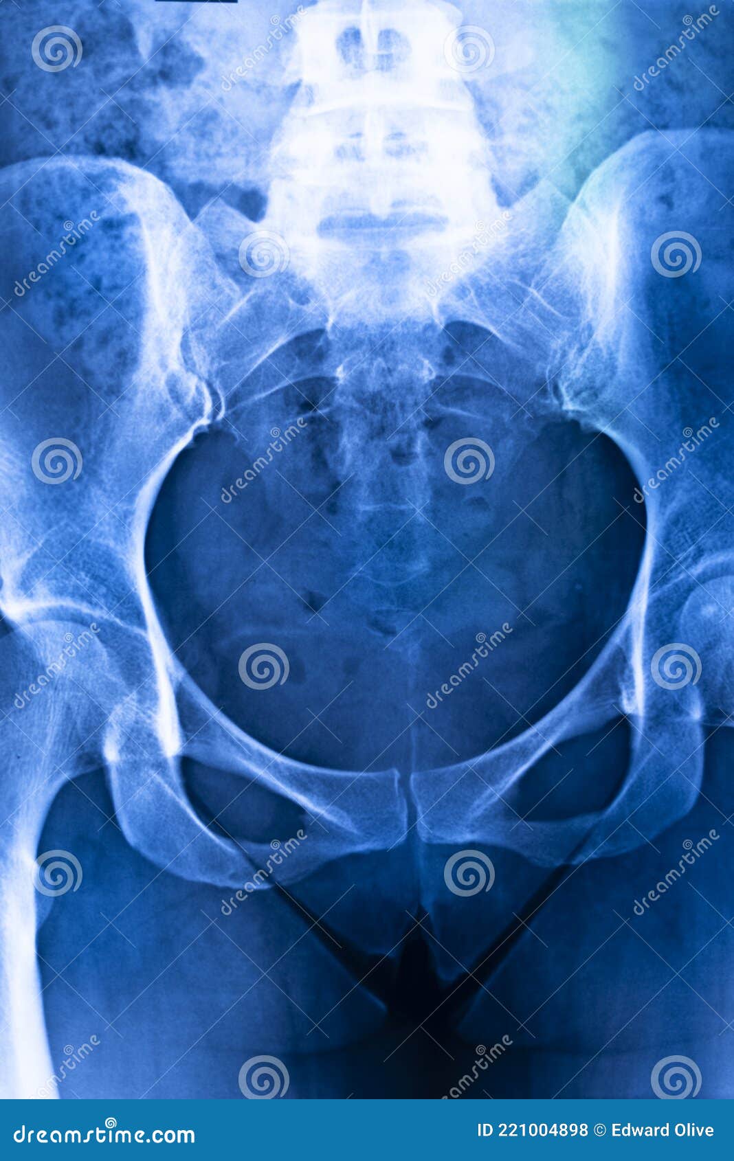 Exploración De Pelvis De Cadera Foto de archivo - Imagen de pierna ...