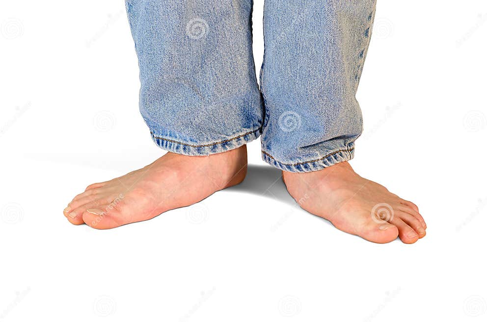 Extemely Flat Feet and Fallen Arches Stock Image - Image of health ...