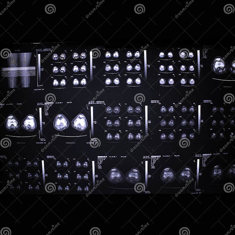 Medical Imaging Techniques Utilized in Analyzing Brain Scans for ...
