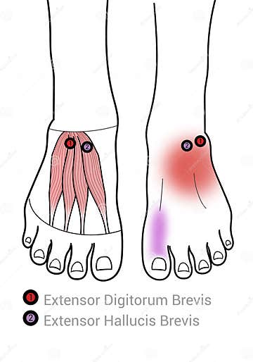 Extensor Digitorum Brevis and Extensor Hallucis Brevis Stock ...