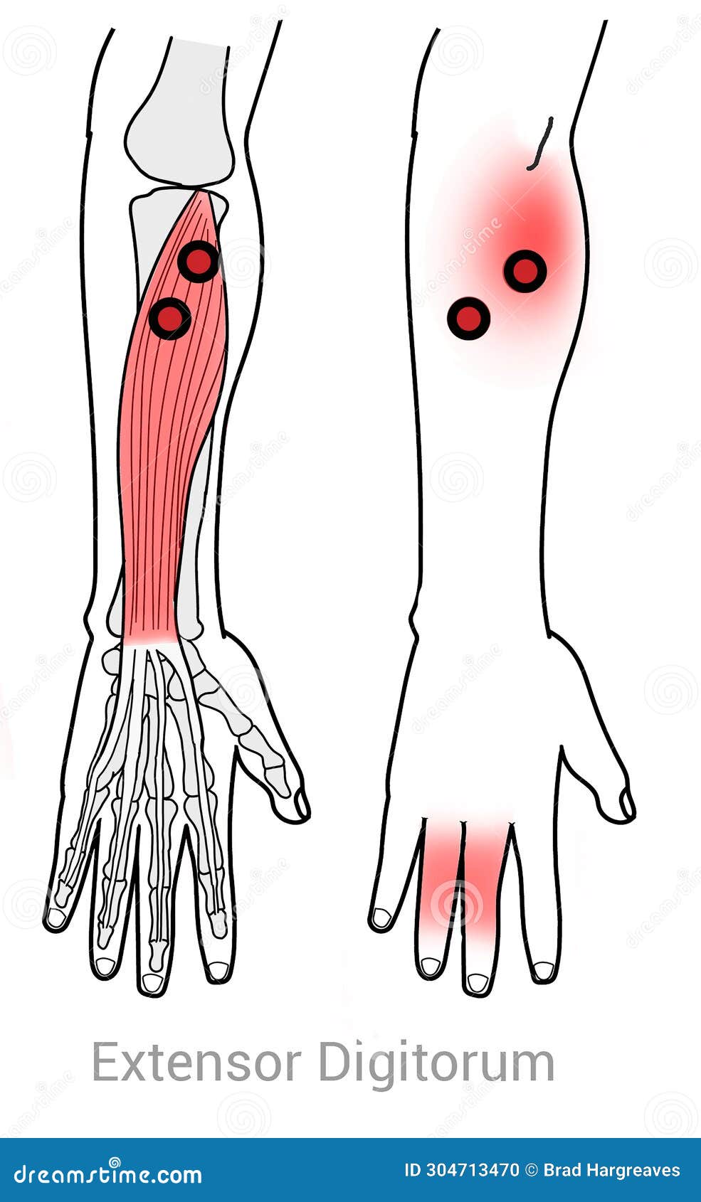 Extensor Digitorum Myofascial Trigger Points Can Cause Pain Around the ...