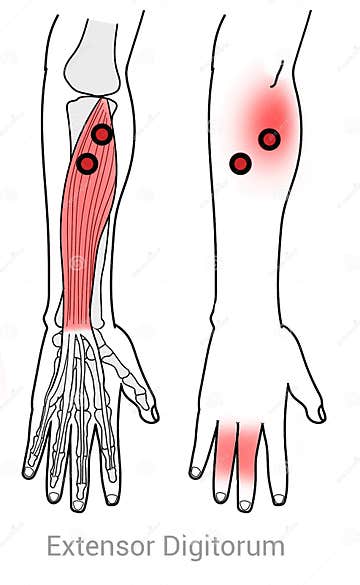 Extensor Digitorum Myofascial Trigger Points Can Cause Pain Around the ...