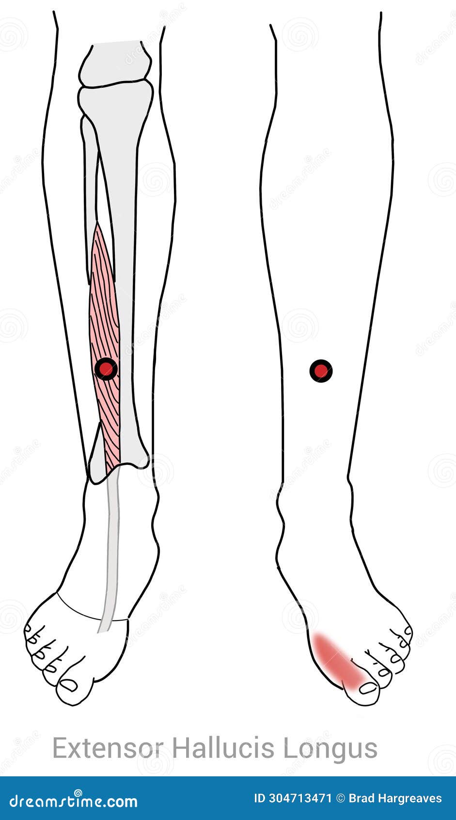 Extensor Hallucis Longus Myofascial Trigger Points Can Cause Big Toe ...