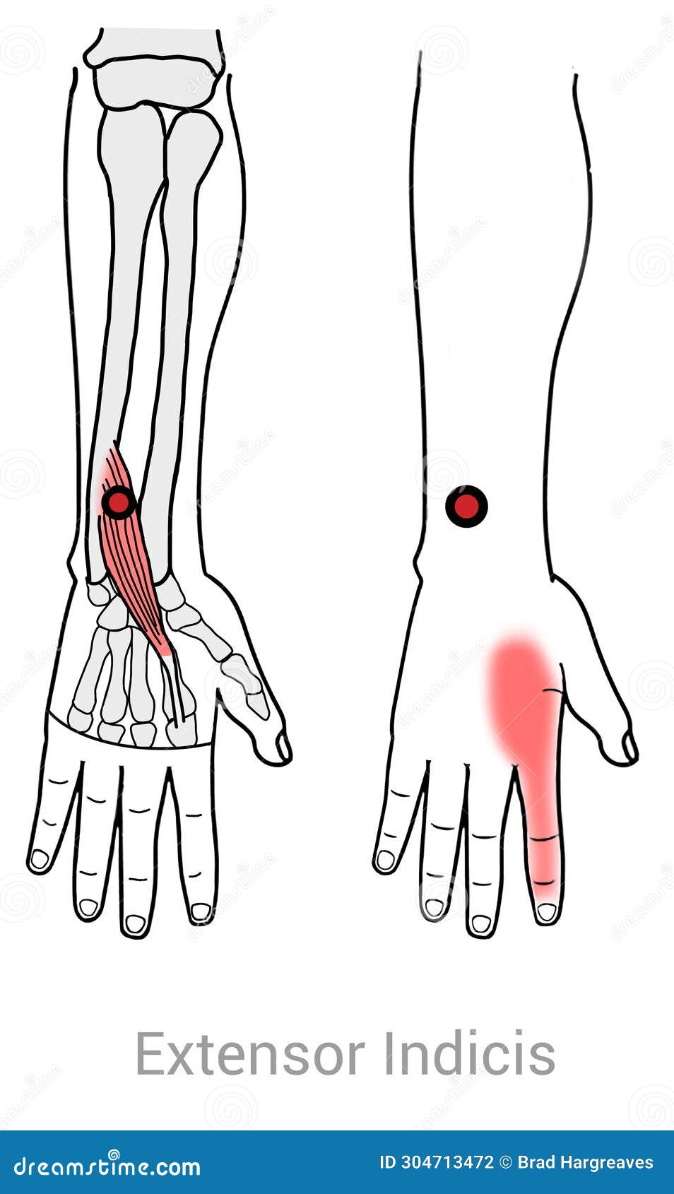 Extensor Indicis Muscle Myofascial Trigger Points Can Cause Index ...