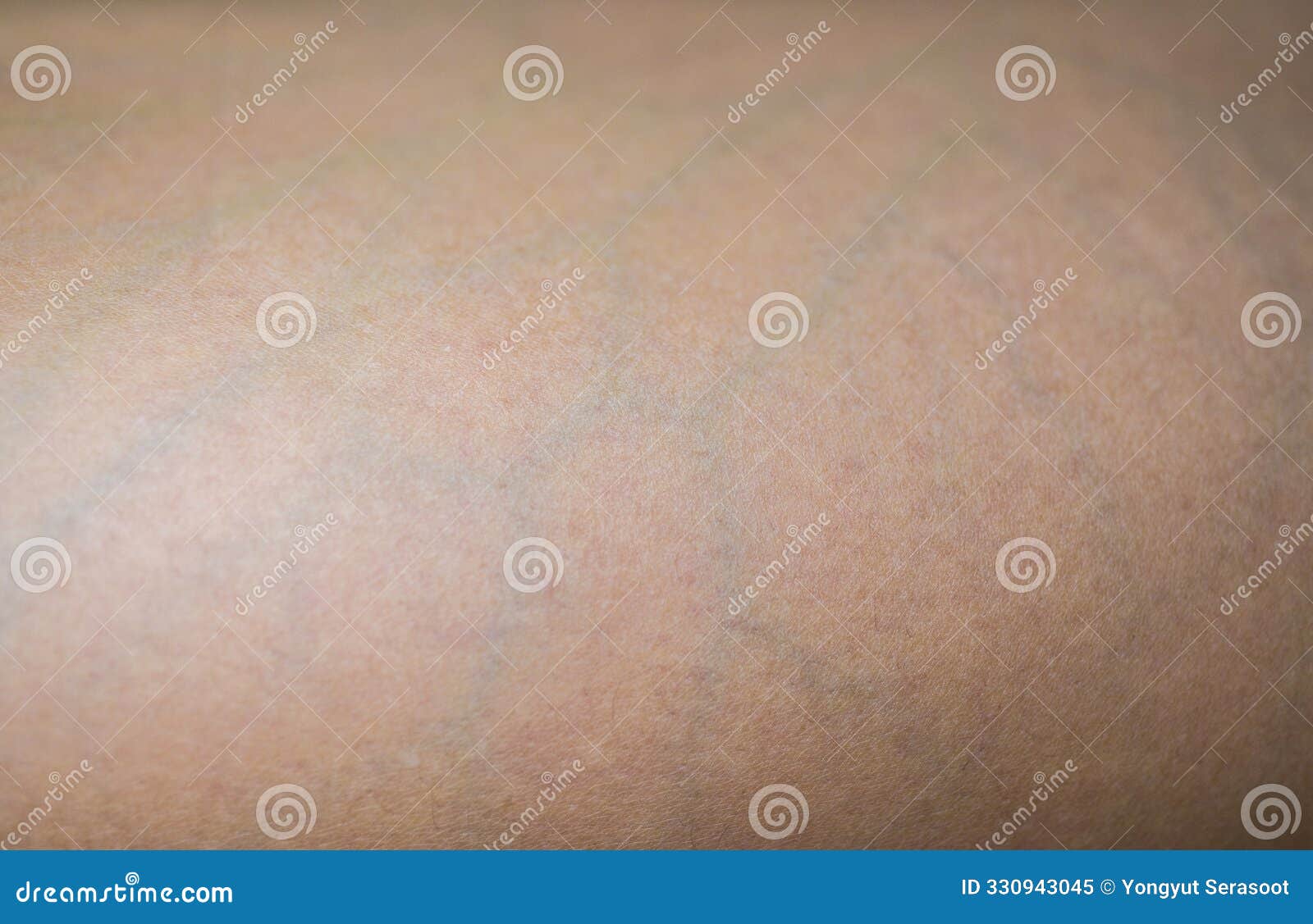 An External Body Surface that Shows the Subcutaneous Vascular ...