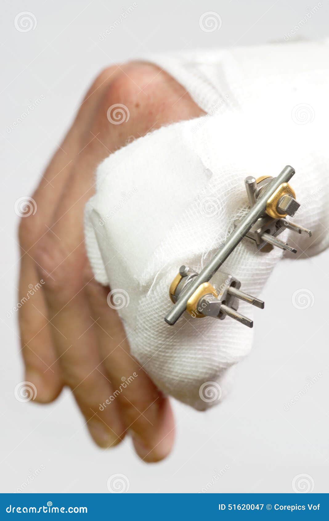 Externe Installatie Om Een Gebroken Hand Te Herstellen Stock Afbeelding ...