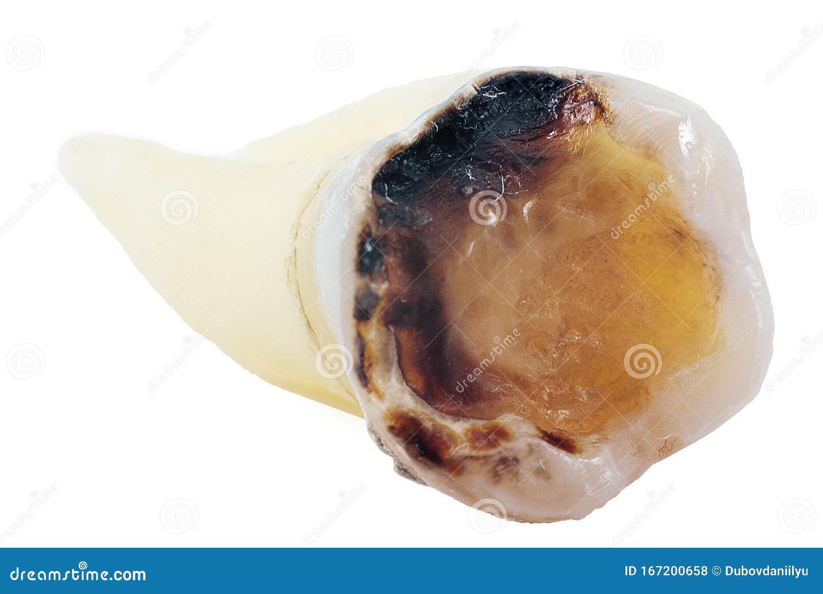 Extracted caries tooth stock photo. Image of caries - 167200658