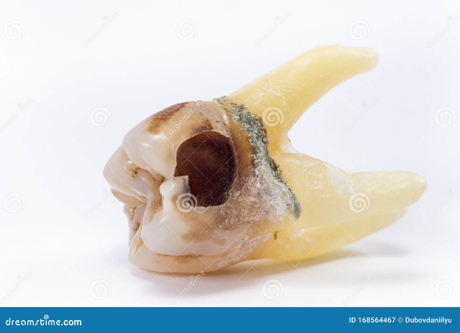Extracted Caries Tooth Isolated Stock Image - Image of dentistry ...