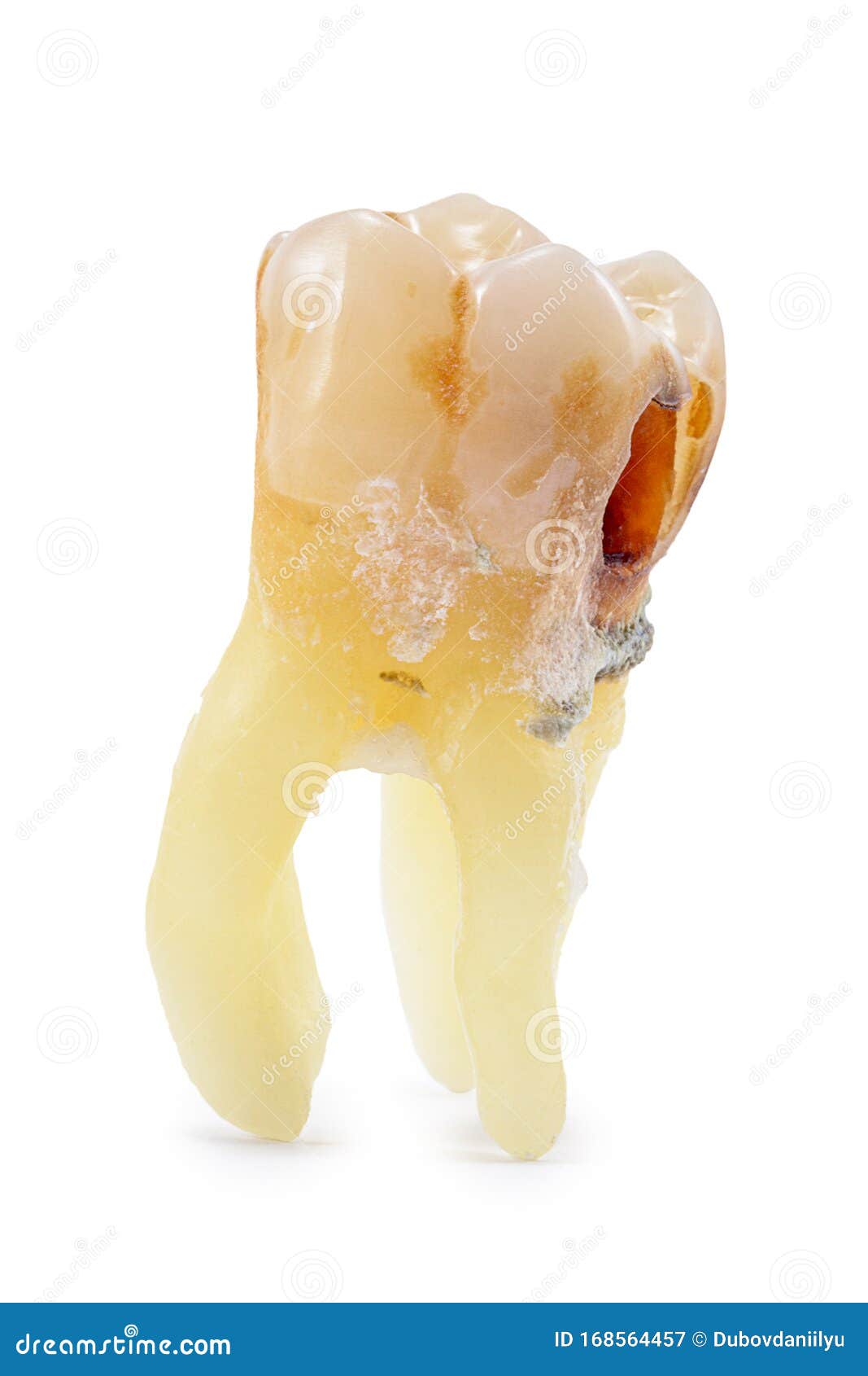 Caries Tooth Extraction By The Dentist. Dentistry In Hospital Stock ...